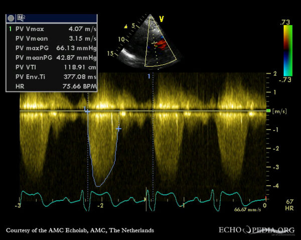 Pocus-Ultraschall in der Medizin: Ein Überblick