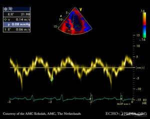 Der CW-Doppler-Ultraschall (Continuous-Wave-Doppler)